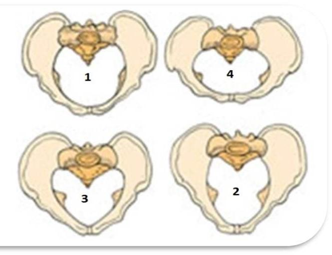 Pelve Ginecoide Anatomía De La Pelvis Femenina (Obstetricia) | PPTX